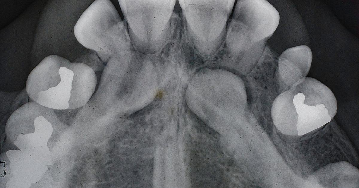 Impacted Canines: What Parents Need to Know for Early Detection and ...