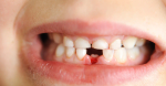 Understanding Delayed Shedding of Baby Teeth in Children: Causes and ...