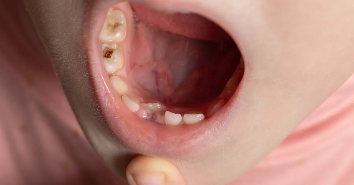 Dangers of Dental Neglect in Children: Why Early Care is Crucial for ...