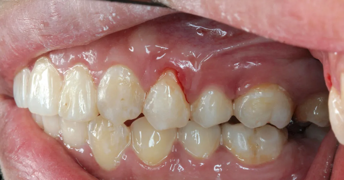 What is Gum Recession: Causes;symptoms and treatment options