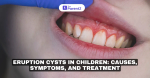 Eruption Cysts in Children: Causes, Symptoms, and Treatment