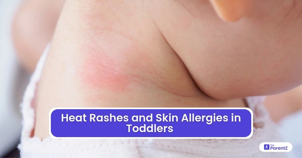 Heat Rashes and Skin Allergies in Toddlers