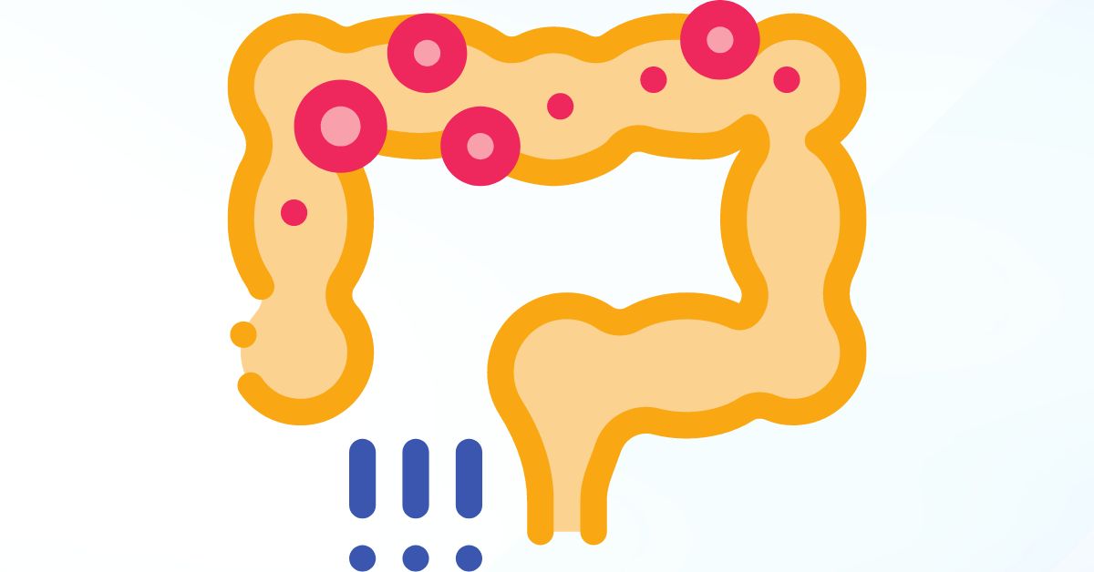 Necrotising Enterocolitis: Causes, Signs, Treatment and Prevention ...