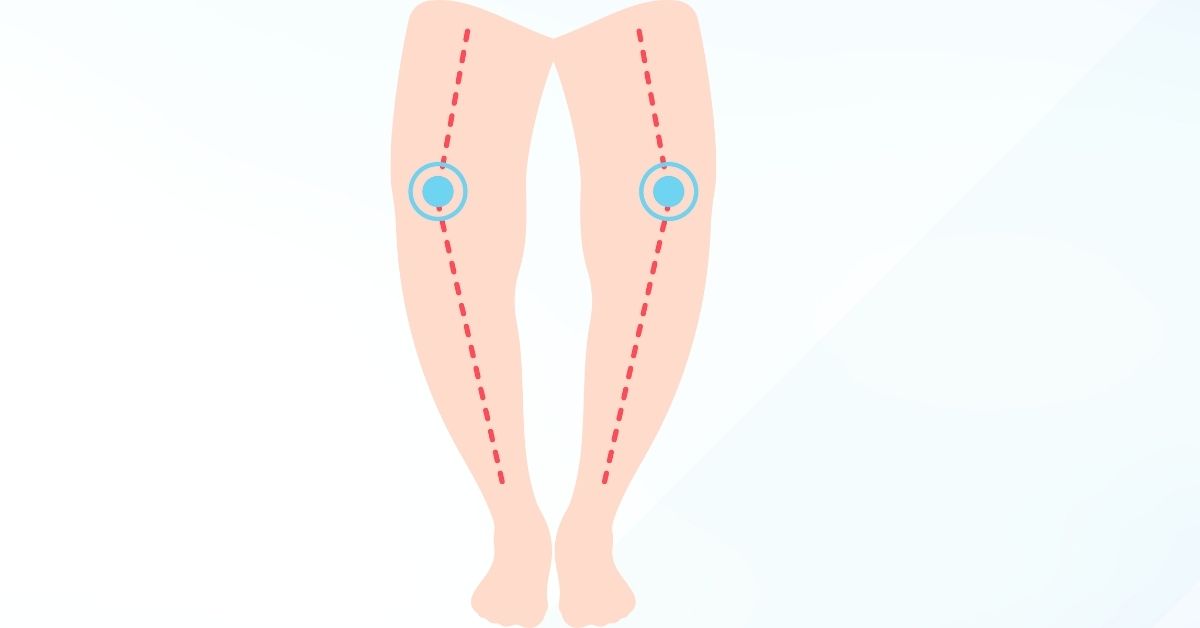Rickets: Signs, Causes and Treatments - The ParentZ