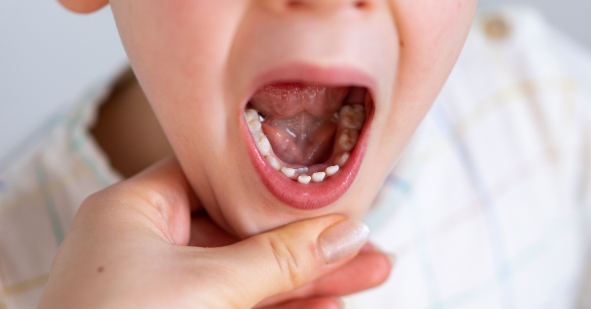 Extra Tooth Trouble: Understanding Supernumerary Teeth in Children