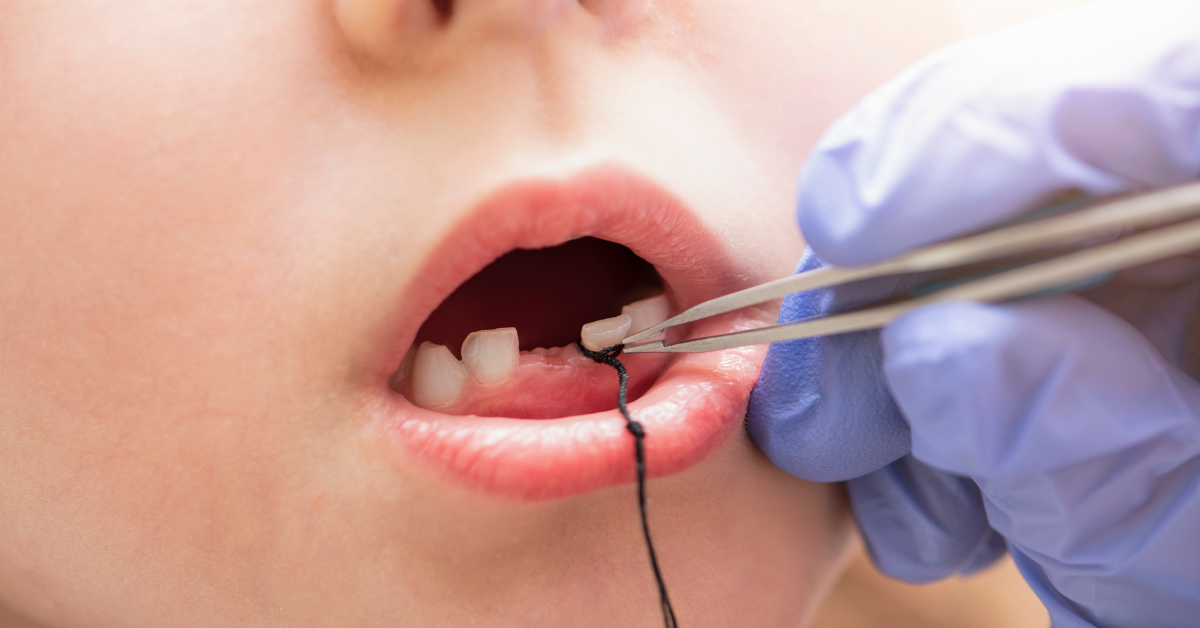 Kid's knocked-out tooth: Quick action steps for saving the tooth